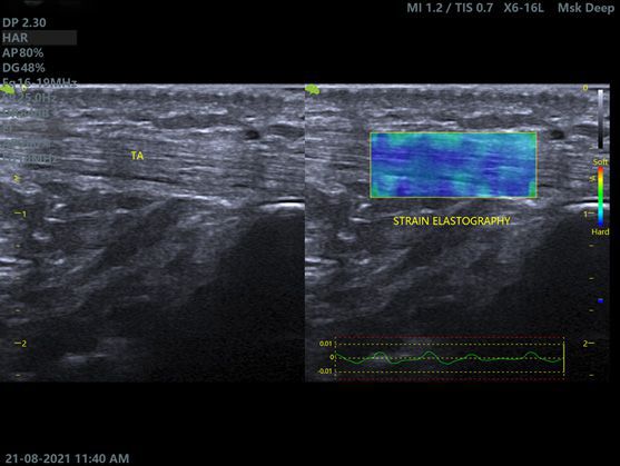 VINNO Strain Imaging : sonoportal.com - Software